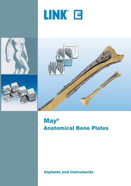 Anatomical Bone Plates