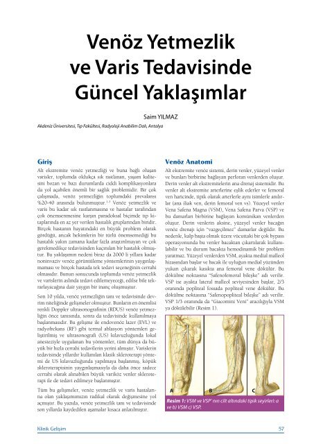 Venöz Yetmezlik ve Varis Tedavisinde Güncel ... - Klinik Gelişim Venöz Yetmezlik ve Varis Tedavisinde Güncel ... - Klinik Gelişim