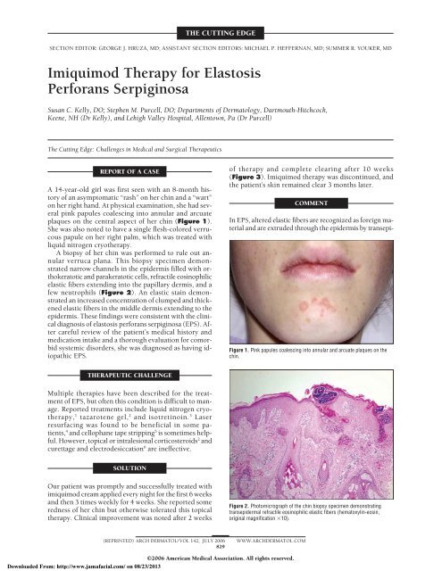 Elastosis Perforans Serpiginosa