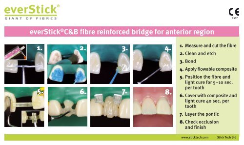 everStick®C&B fibre reinforced bridge for anterior region ... - StickTech