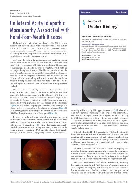 Unilateral Acute Idiopathic Maculopathy Associated with ... - Avens