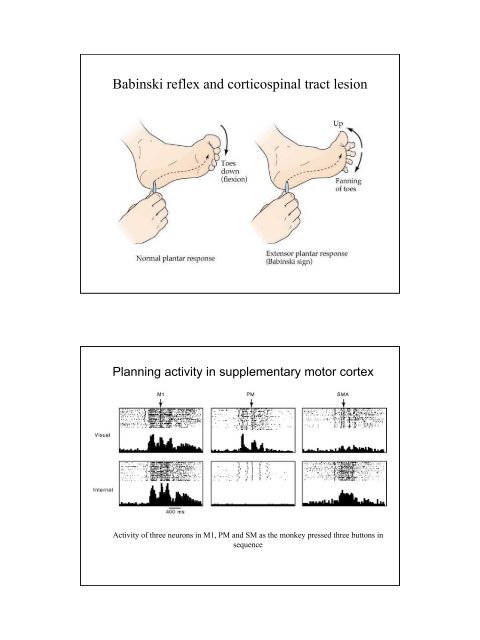 Babinski reflex and corticospinal tract lesion