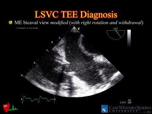 LSVC TEE Diagnosi
