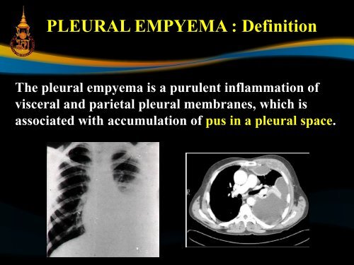 Parapneumonic pleural eff
