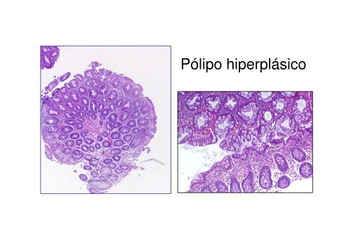 Pólipo hiperplásico