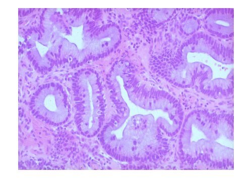 Low grade CGIN(glandular