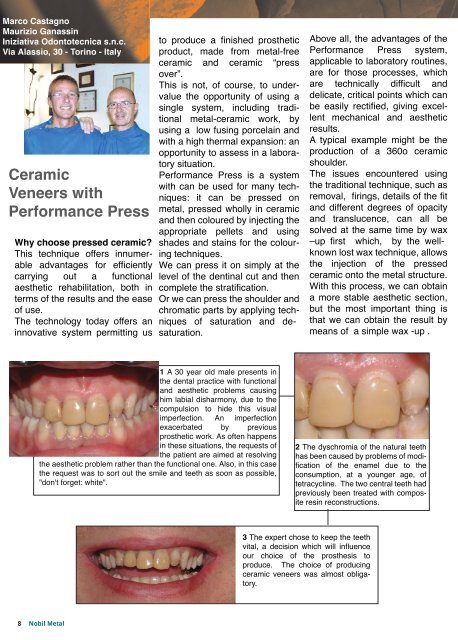 Ceramic Veneers with performance press - Nobil-Metal