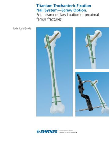 Trofix® Trochanteric Fixation Plate - zimmer2.eu