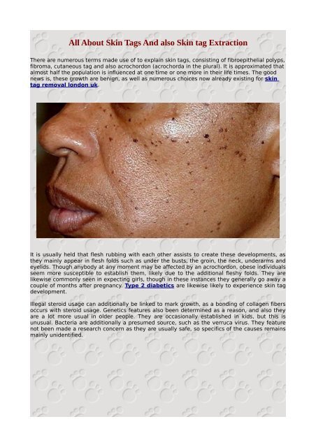 All About Skin Tags And also Skin tag Extraction