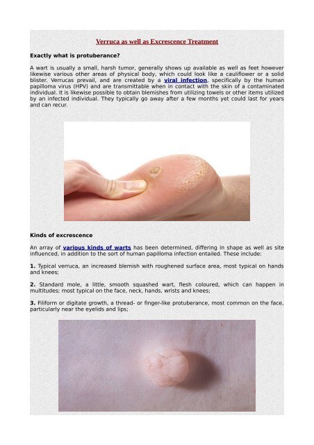 Verruca as well as Excrescence Treatment