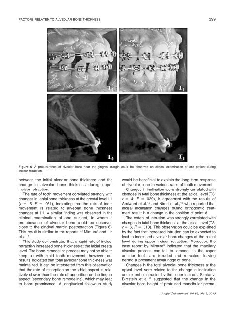 FACTORS RELATED TO ALVEOL