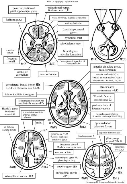 Brain CT topography regio