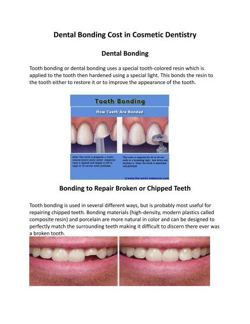 Dental Bonding Cost In Cosmetic Dentistry