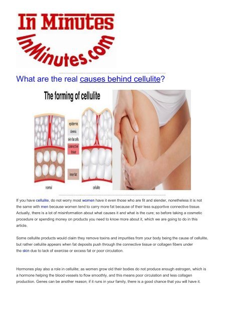 What are the real causes behind cellulite