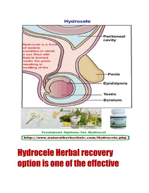 Hydrocele Herbal Treatment