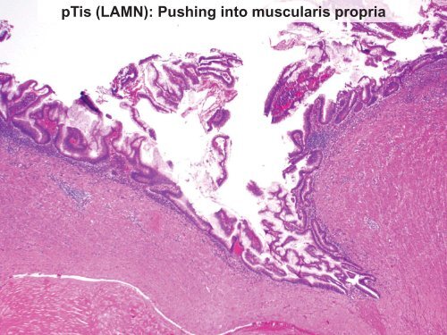 pTis (LAMN): Pushing into