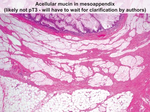 LAMN: AJCC 8 th Editi