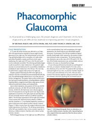 The Spaeth Gonioscopic Grading System - Glaucoma Today