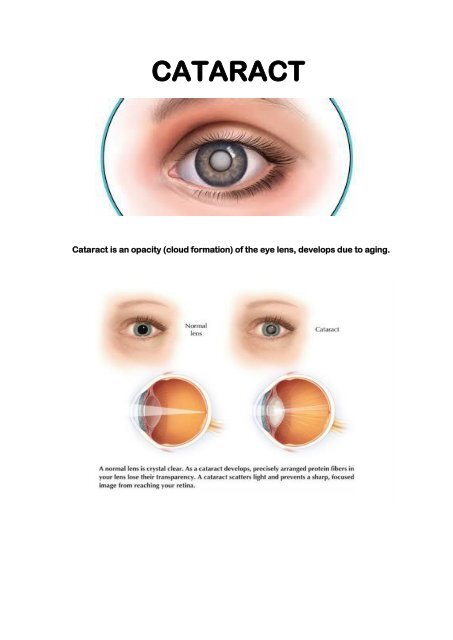 CataractEyeDrop
