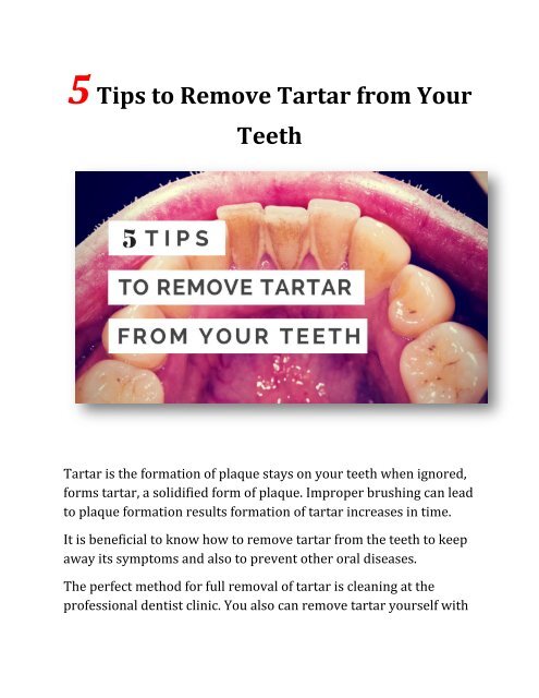 5 Tips to Remove Tartar from Your Teeth