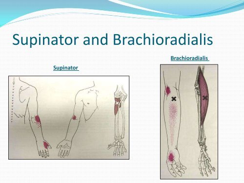 Supinator and Brachioradi