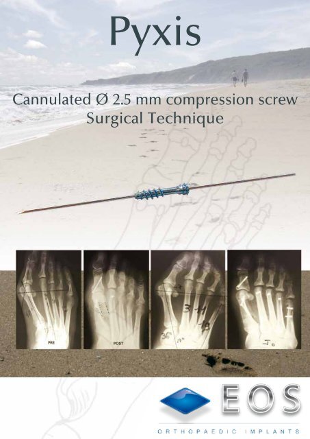 Metatarsal osteotomy - Int2Med