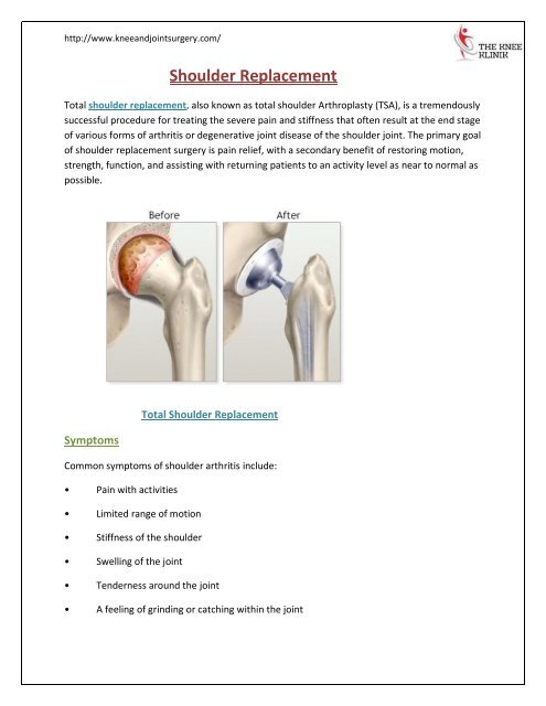 Shoulder Replacement PDF