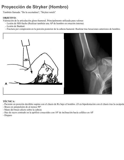 Proyección de Stryker
