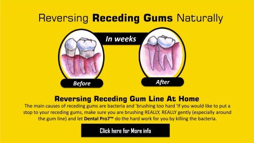 Reversing Receding Gums