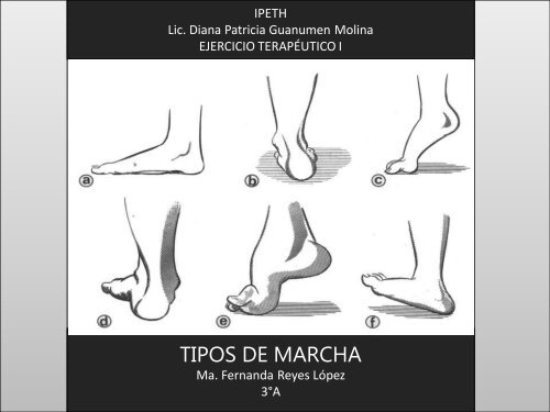marchas patologicas