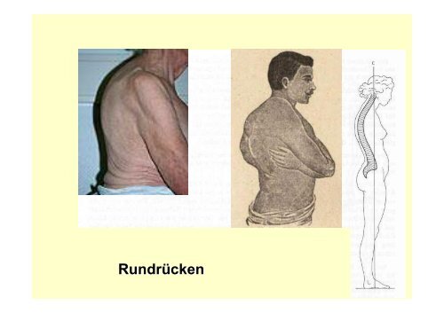 Rundrücken Rundr cken