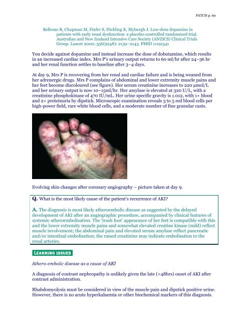 Treatment of oliguria The