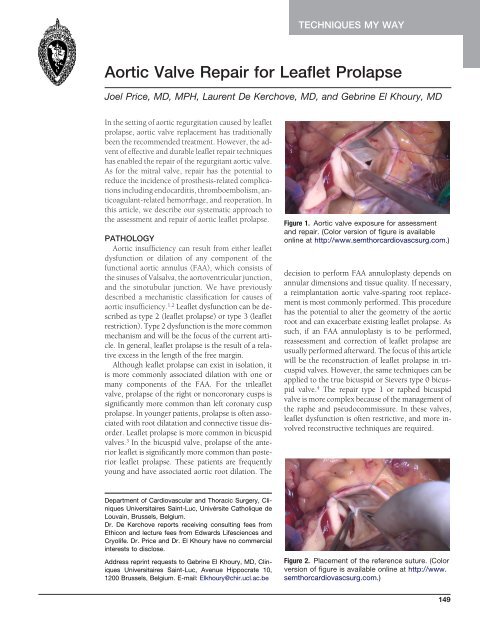 Aortic Valve Repair for Leaflet Prolapse