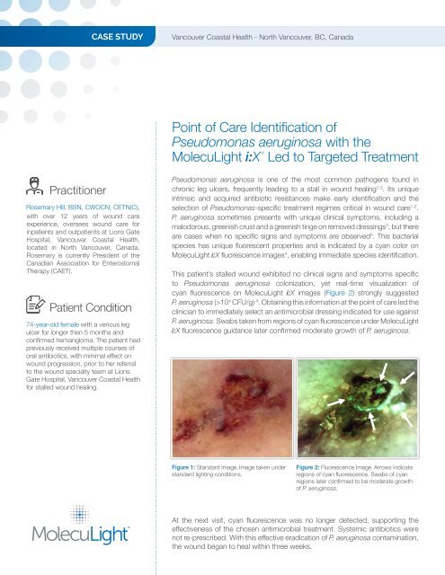 MolecuLight i:X Case Study - Pseudomonas