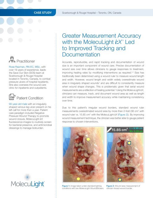 MolecuLight i:X Case Study - Irregular Wound Measurement