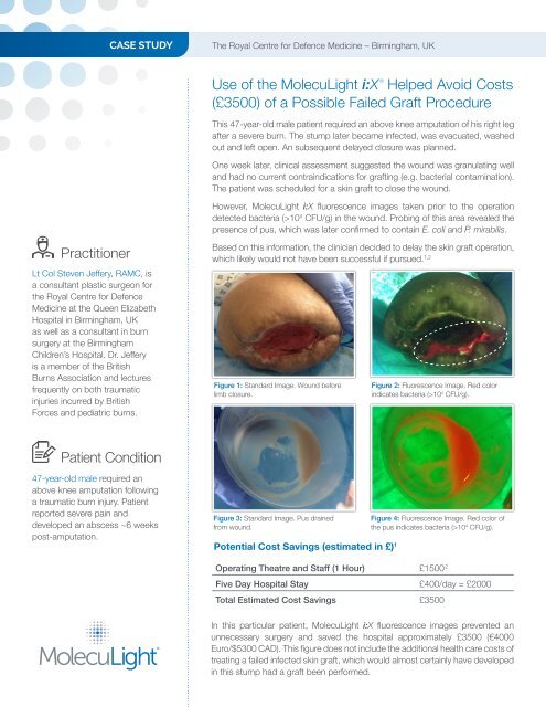 MolecuLight i:X Case Study - Amputation & Health-Economics