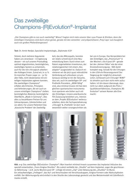 Das zweiteilige Champions-(R) - Champions-Implants