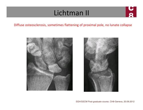 Lichtman II Diffuse osteo