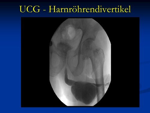 UCG - Harnröhrendivertik