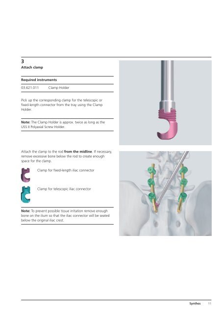 Iliac Fixation