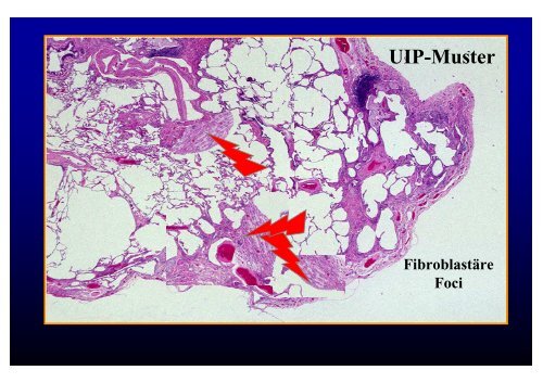 UIP-Muster Fibroblastäre