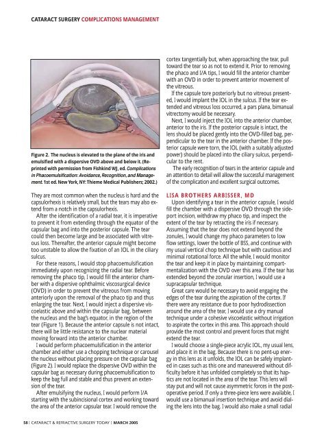 CATARACT SURGERY COMPLICA