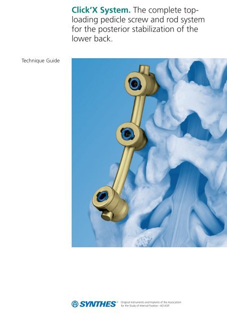 Click'X System. The complete top- loading pedicle screw ... - Synthes