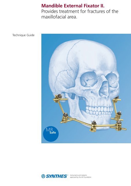 Mandible External Fixator II. Provides treatment for ... - Synthes