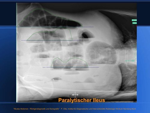 Paralytischer Ileus "Akut