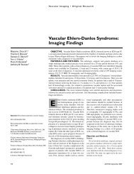 Vascular Ehlers Danlos Syndrome (EDS type IV