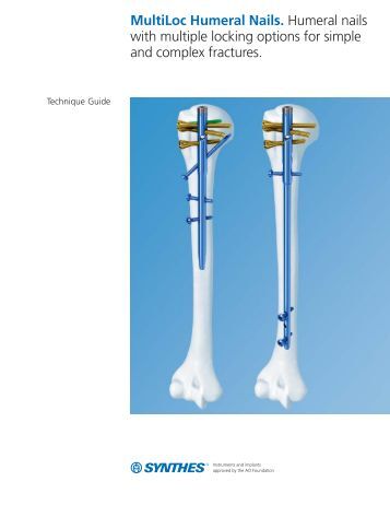 UHN/PHN Humeral Nailing System. - Osteosyntese
