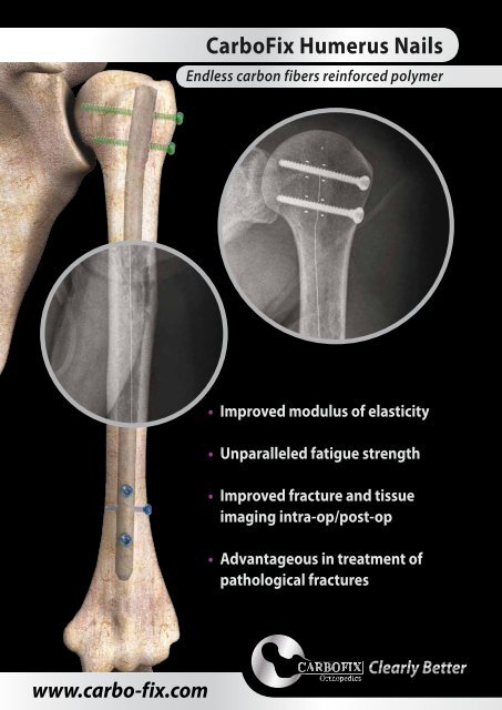 CarboFix Humerus Nails - Carbo-Fix > Company