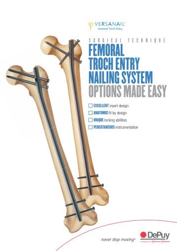 Phoenix™ Antegrade Femoral Nail System Featuring ... - Biomet