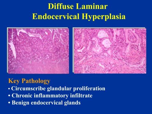Lobular Hyperplasia Key p